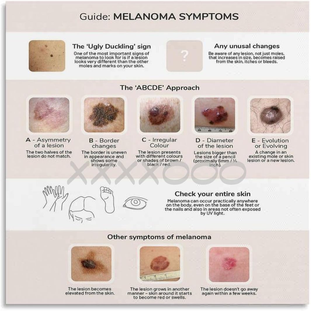 Amazon.com: Generic Skin Cancer Poster Symptoms of Melanoma Canvas ...