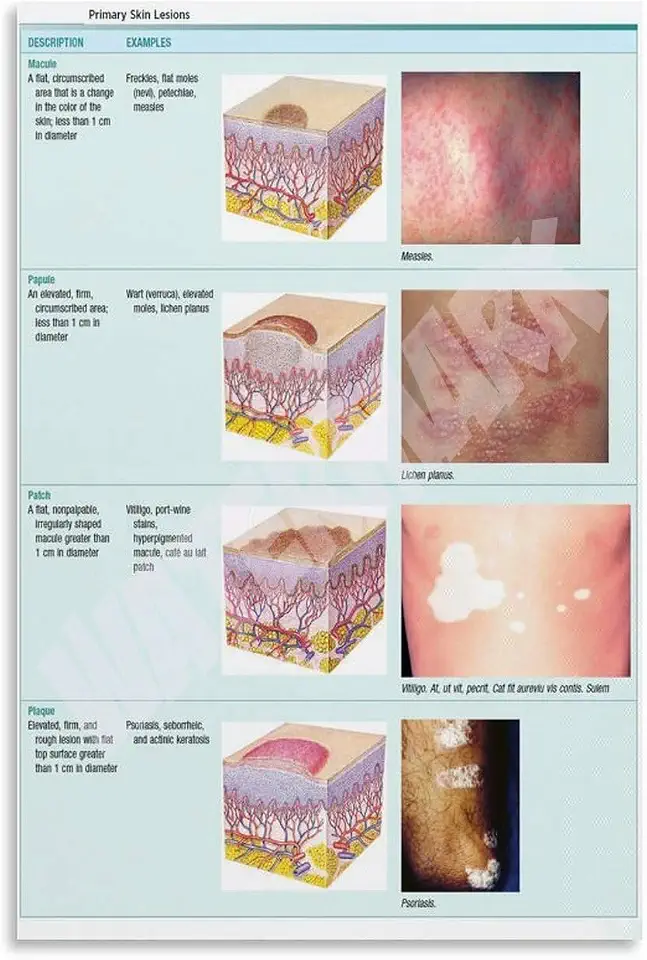 Understanding The Types Of Fluid-Filled Sac Lesions Under The Skin ...