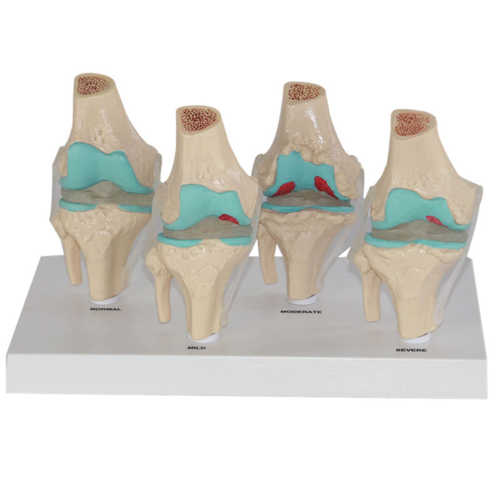 Buy Four Sets Human Knee Model Normal And Abnormal Knee Joints Model ...