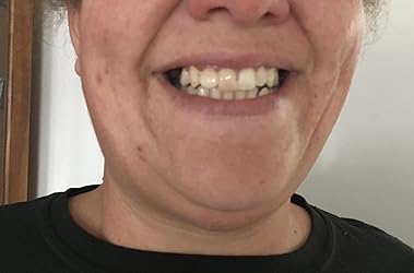 CREADENT Kit for replacing a missing tooth with a temporary cosmetic ...