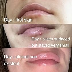 Amazon.com: Releev 1 Day Cold Sore Treatment 6ML : Health & Household