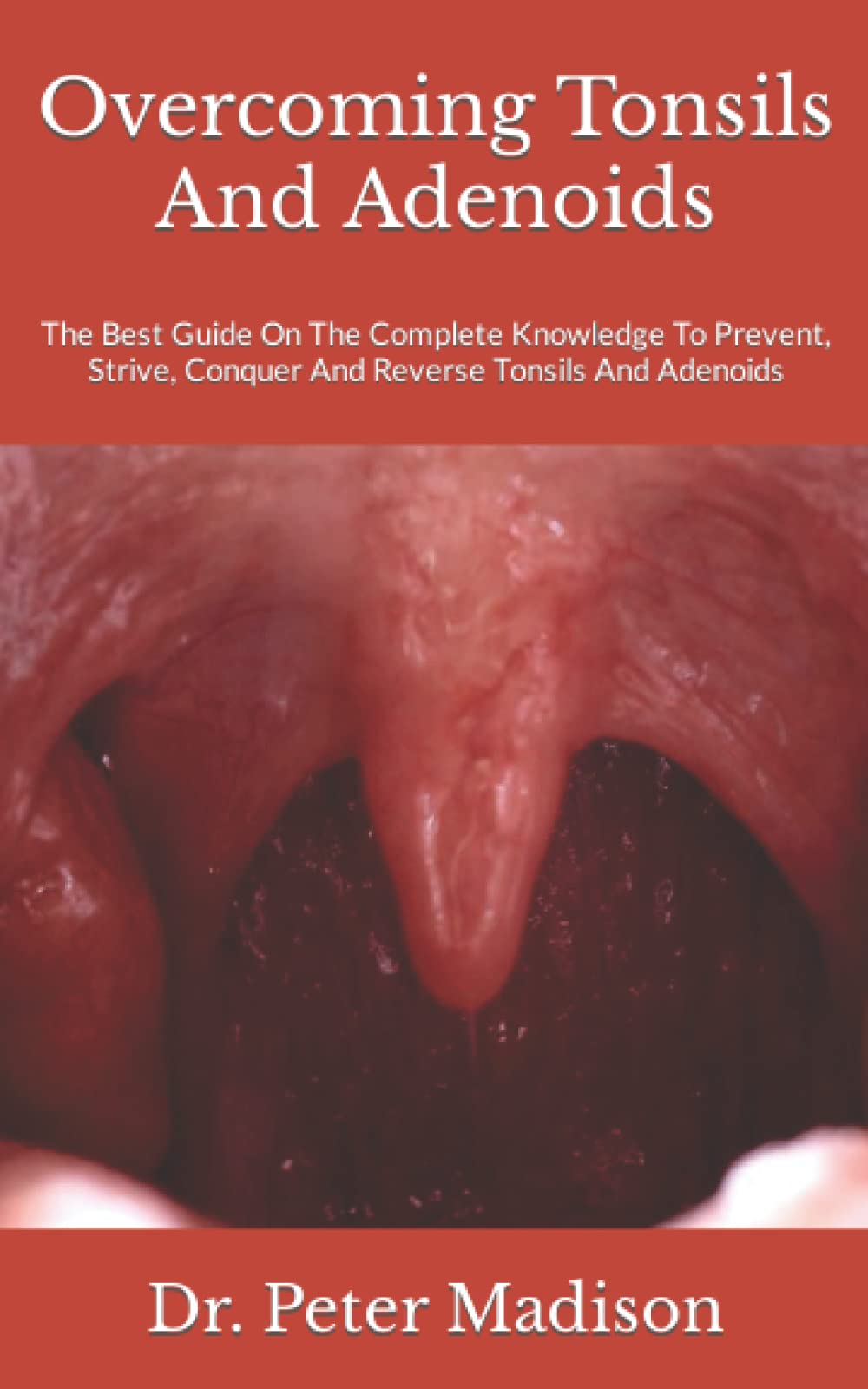 Buy Overcoming Tonsils And Adenoids: The Best Guide On The Complete ...