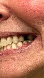 Amazon.com: Temptooth #1 Seller Trusted Patented Temporary Tooth ...