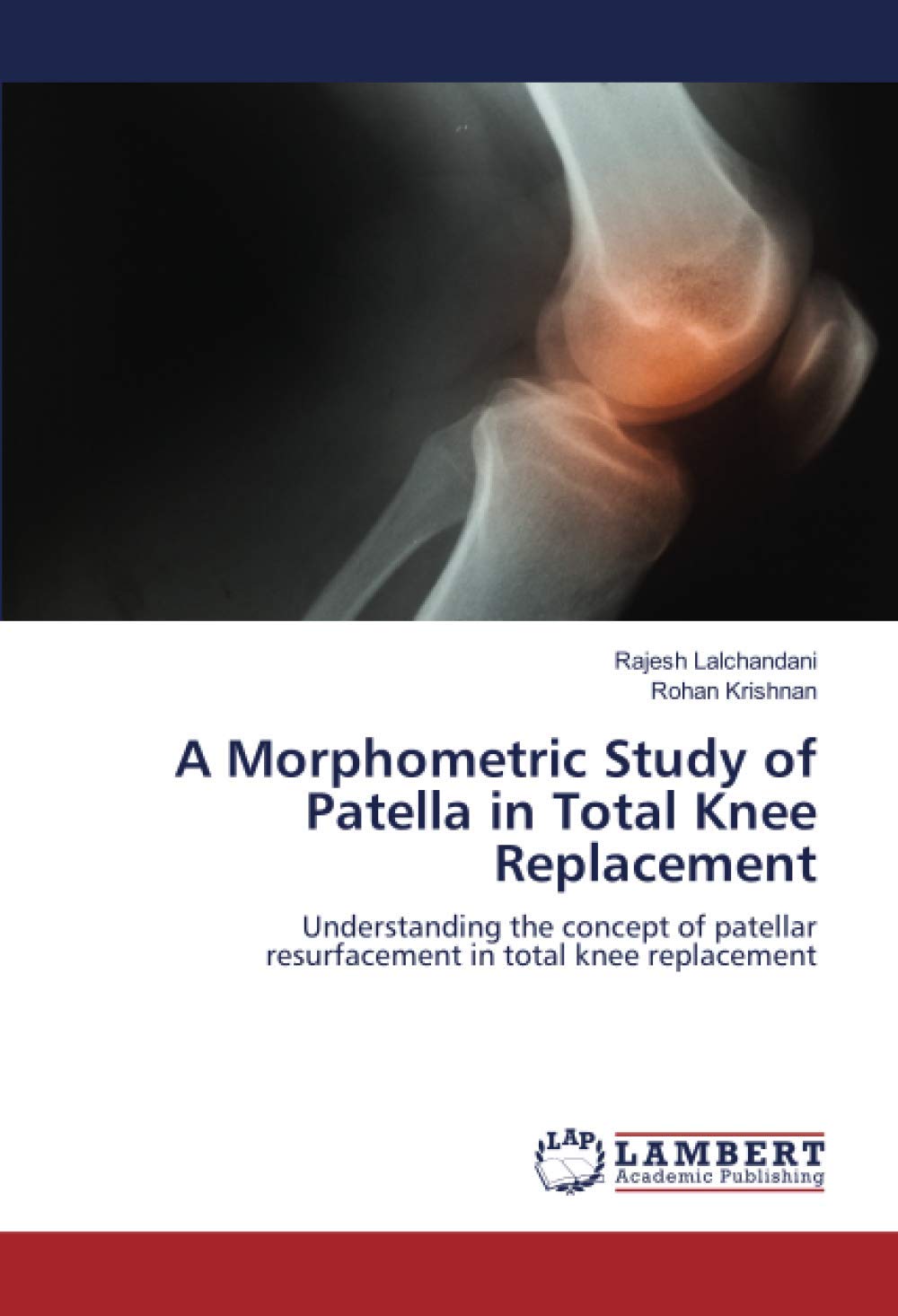 Buy A Morphometric Study Of Patella In Total Knee Replacement buy-a-morphometric-study-of-patella-in-total-knee-replacement