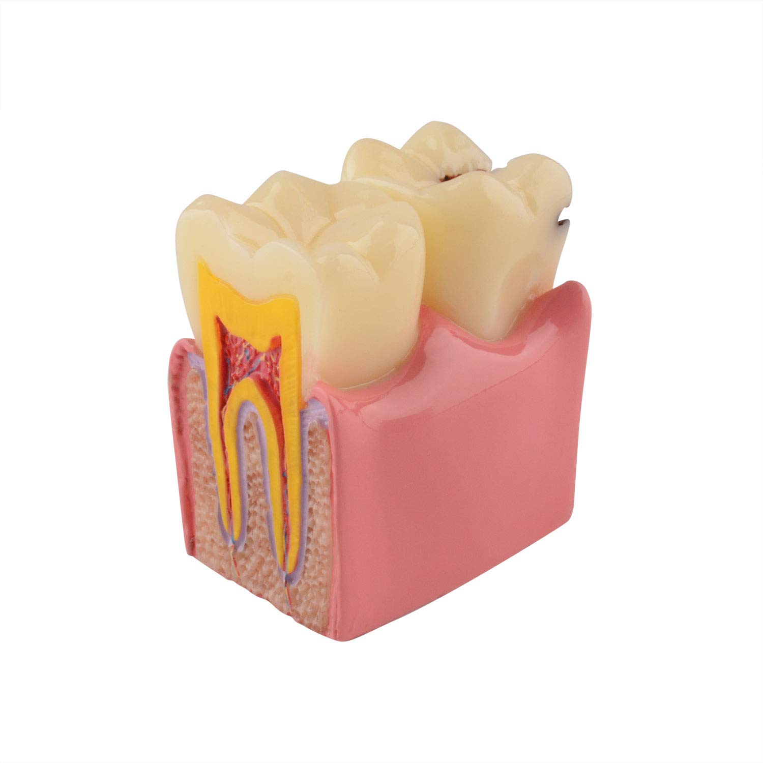 Snapklik.com : Ultrassist Dental Tooth Decay Model 6 Times Dental ...