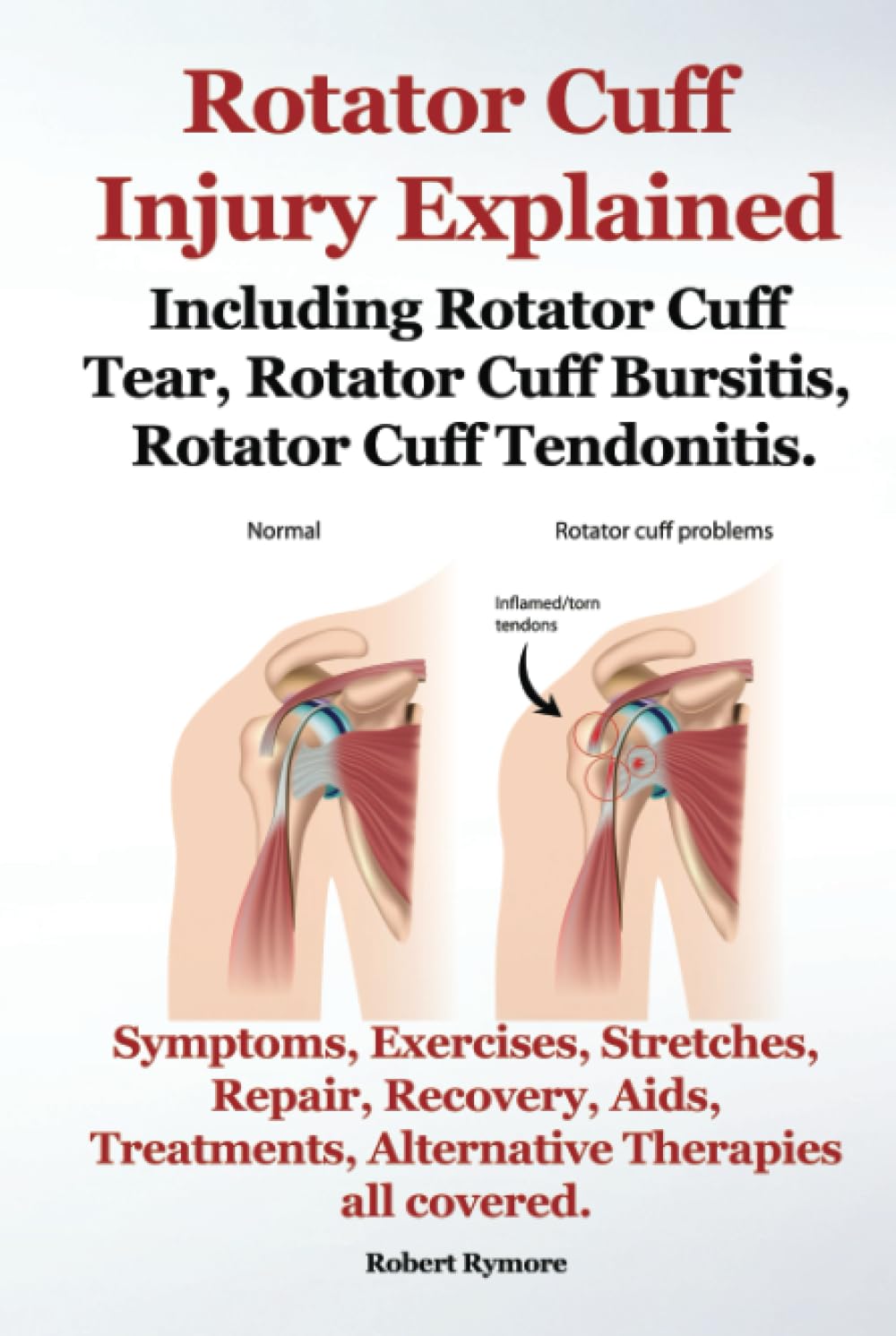 Rotator Cuff Injury Explained. Including Rotator Cuff Tear, Rotator ...
