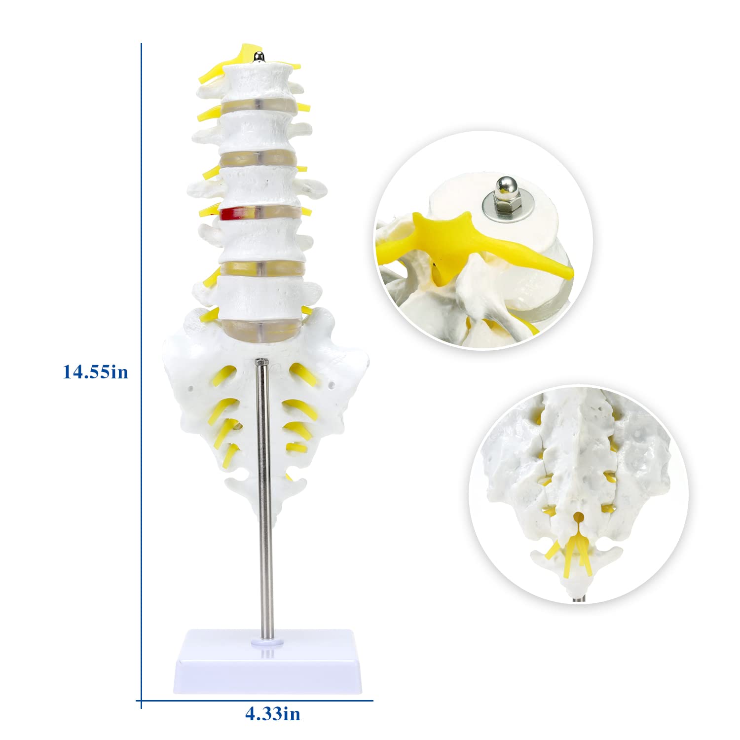 Anatomy Poster Human Anatomical Lumbar Disc Herniation Model, Life ...