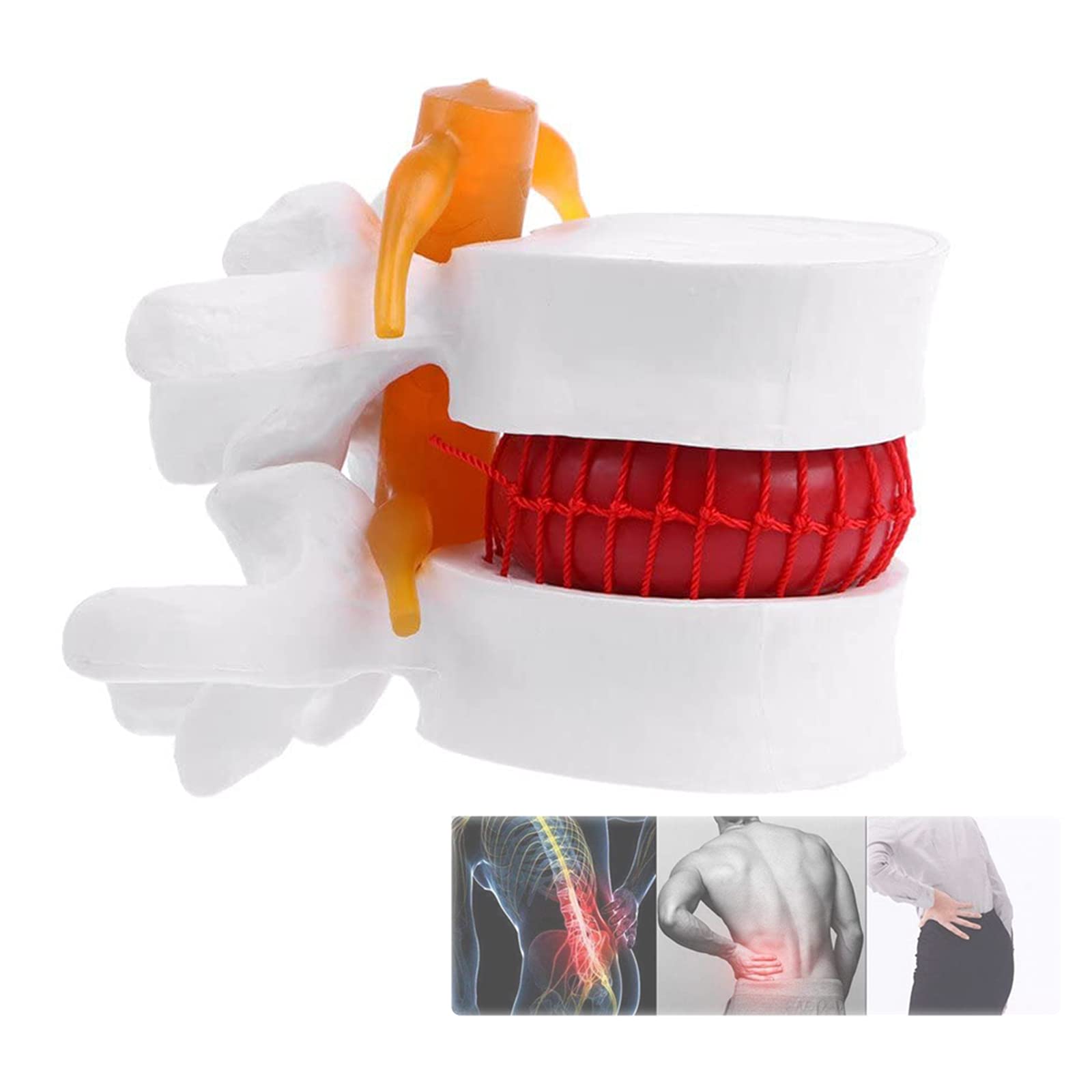 Human Lumbar Disc Herniation Model Anatomical Model Of Lumbar Vertebral ...