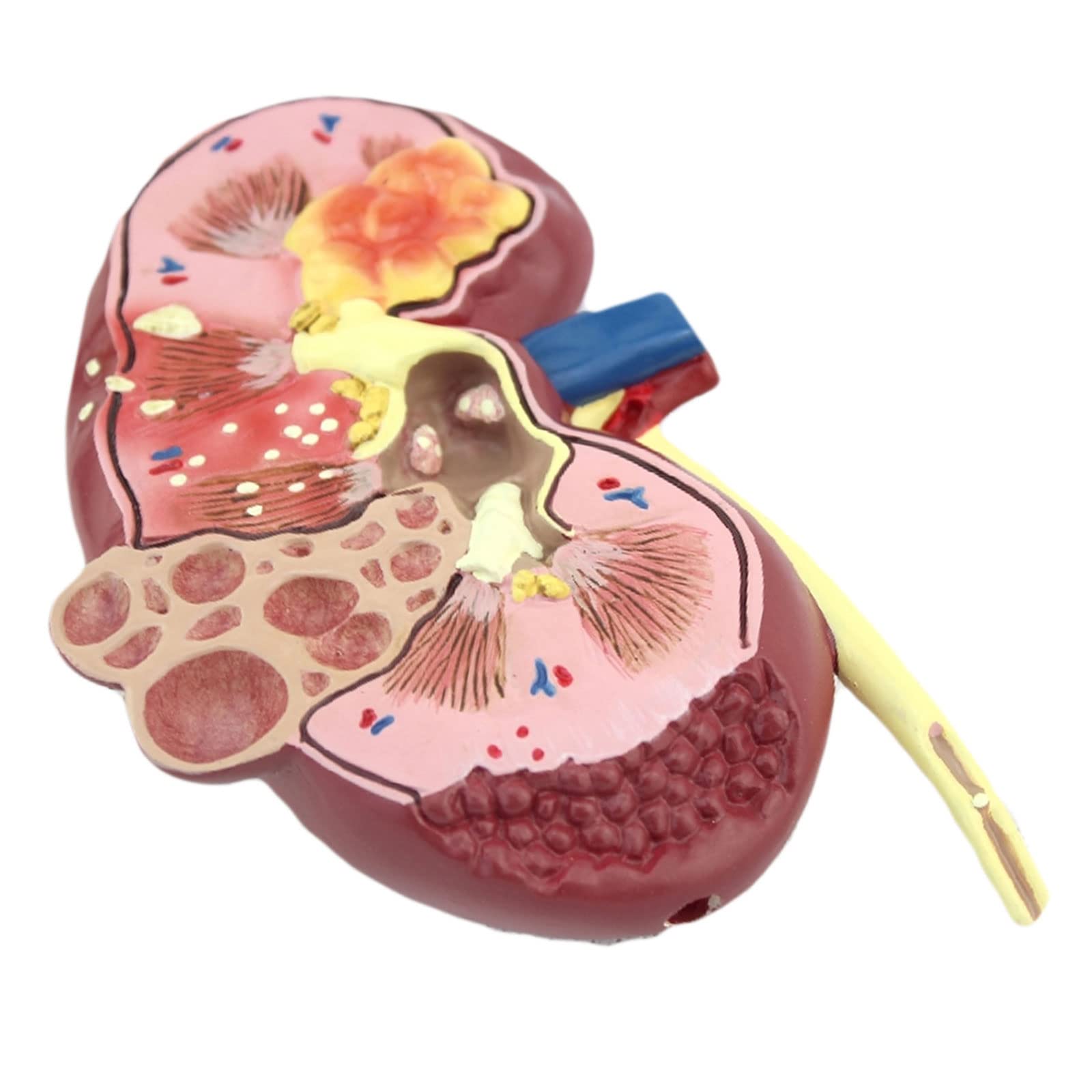 Buy LBYLYH Kidney Stones Disease Model Urology Kidney Nephron Renal ...