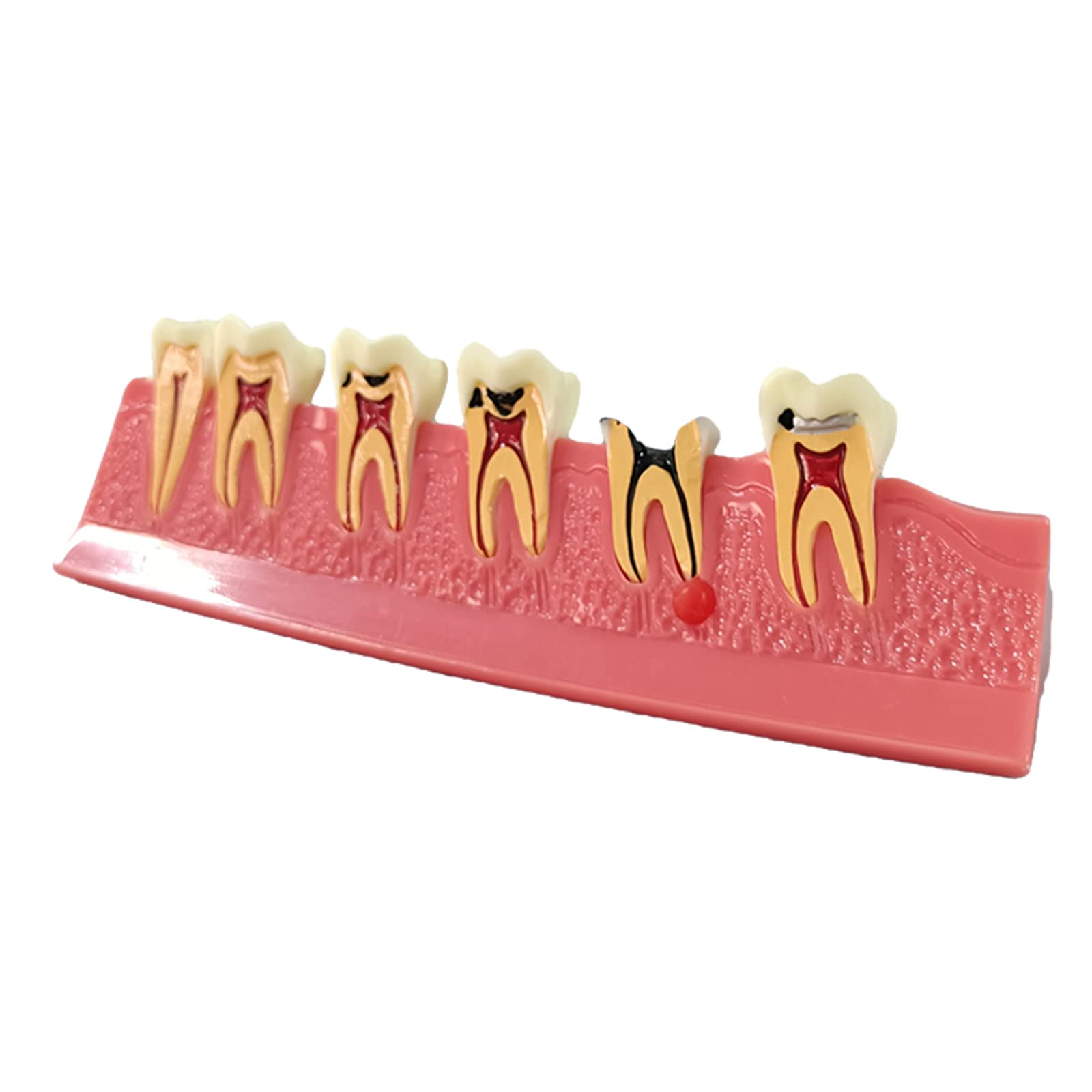 Pathological Tooth Model For Dental Students Dental Caries Model ...