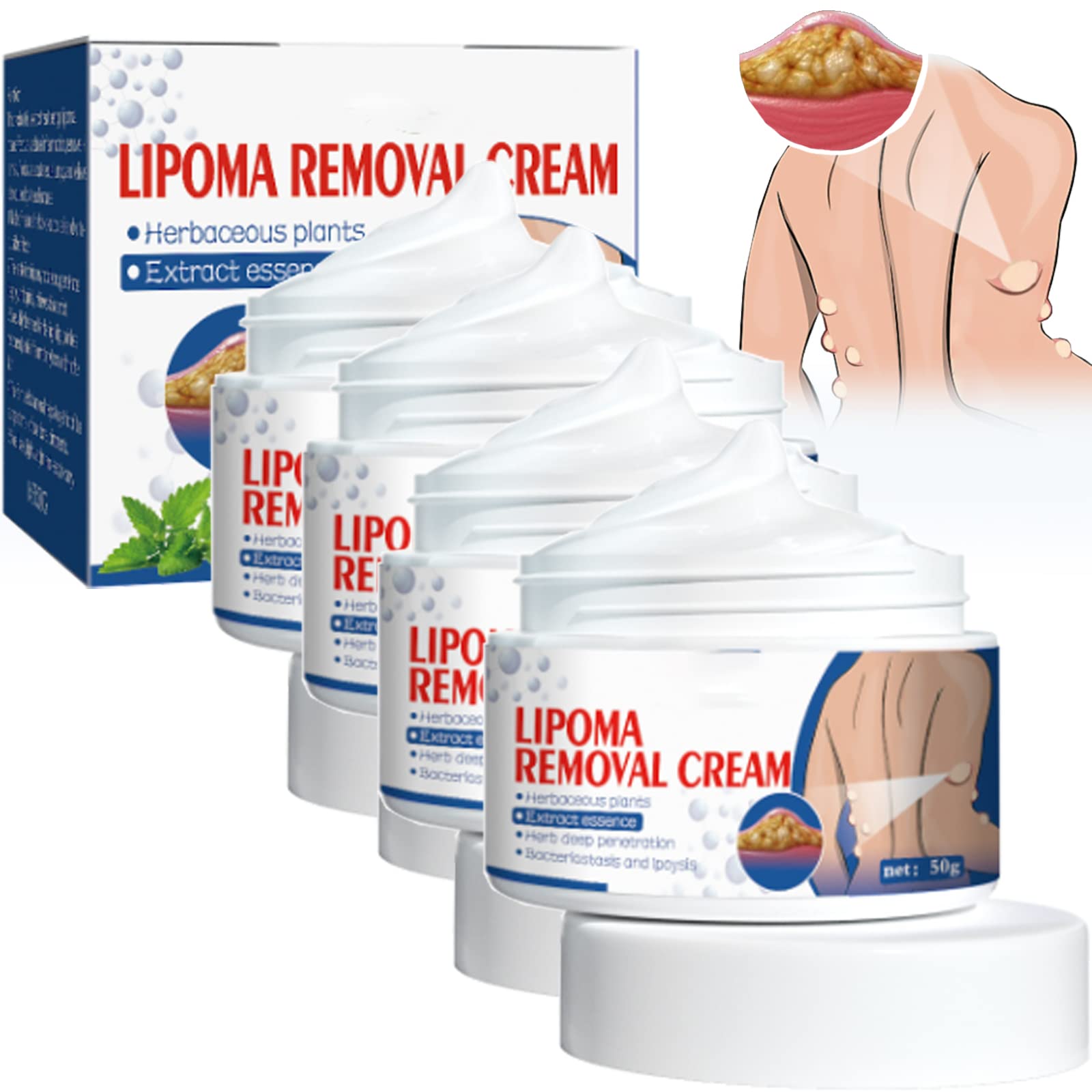 Buy Instant Lipoma Removal Cream, Lumpfree Lipoma Removal Cream ...