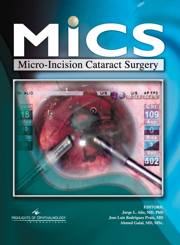 MICS Microincision Cataract Surgery: ALIO, ALIO, ALIO: 9789962613305 ...