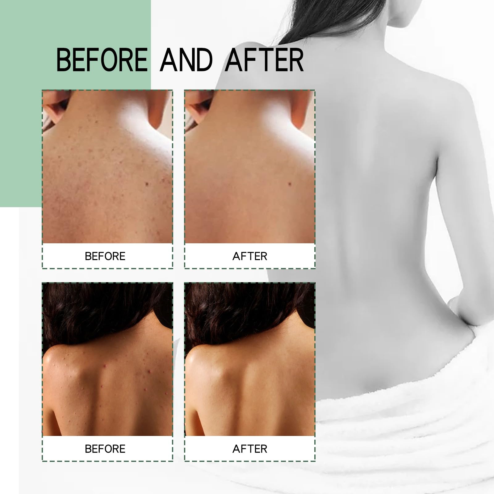 Snapklik.com : Back Acne Spray, Back Acne Treatment, 2% Salicylic Acid ...