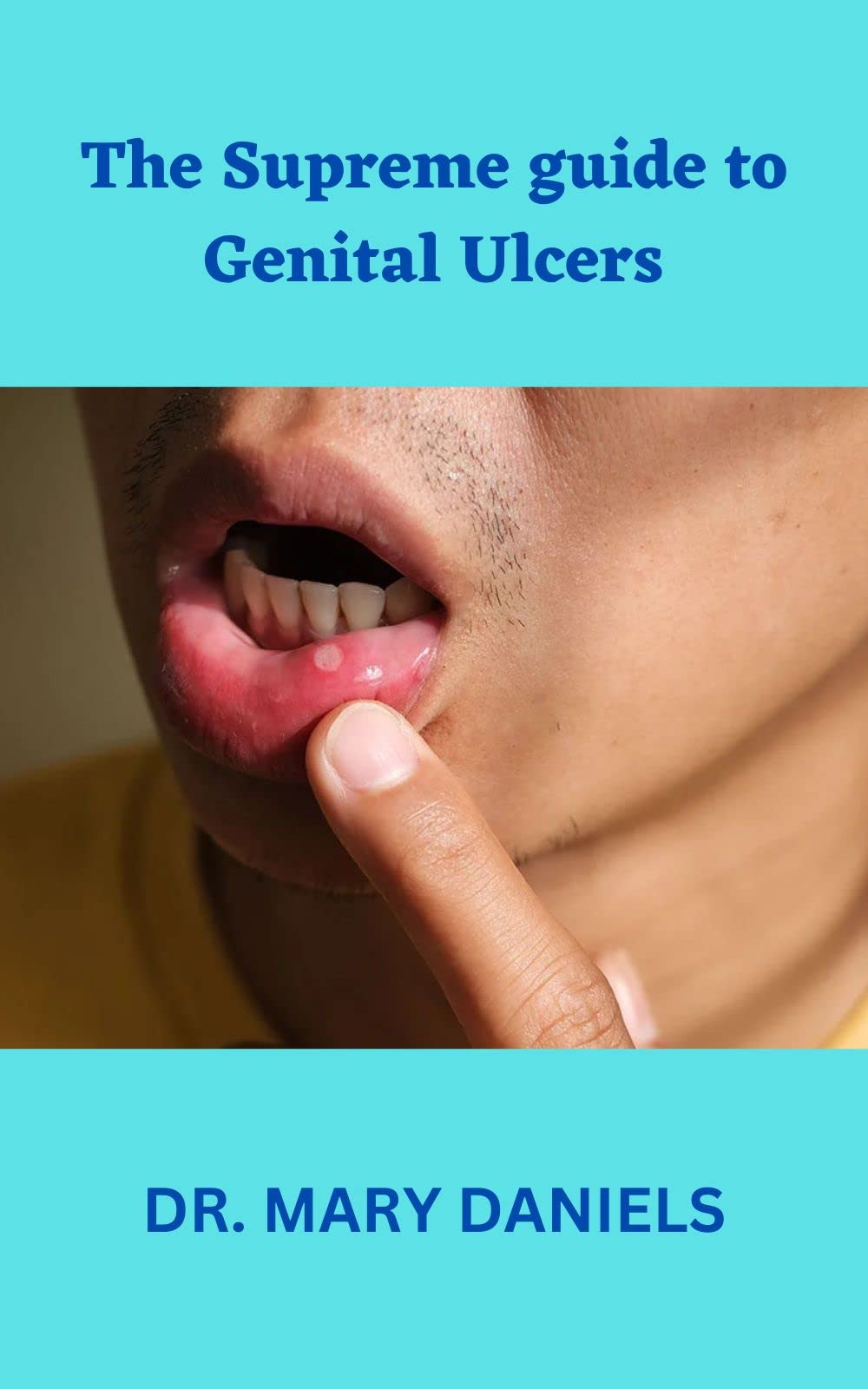 Buy The Supreme guide to Genital Ulcers: GENITAL ULCER DISEASE SYNDROME ...