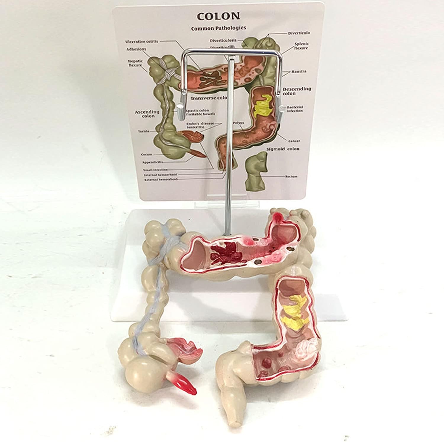 Human Digestive System Model, Life Size Human Rectal Pathology Colon ...