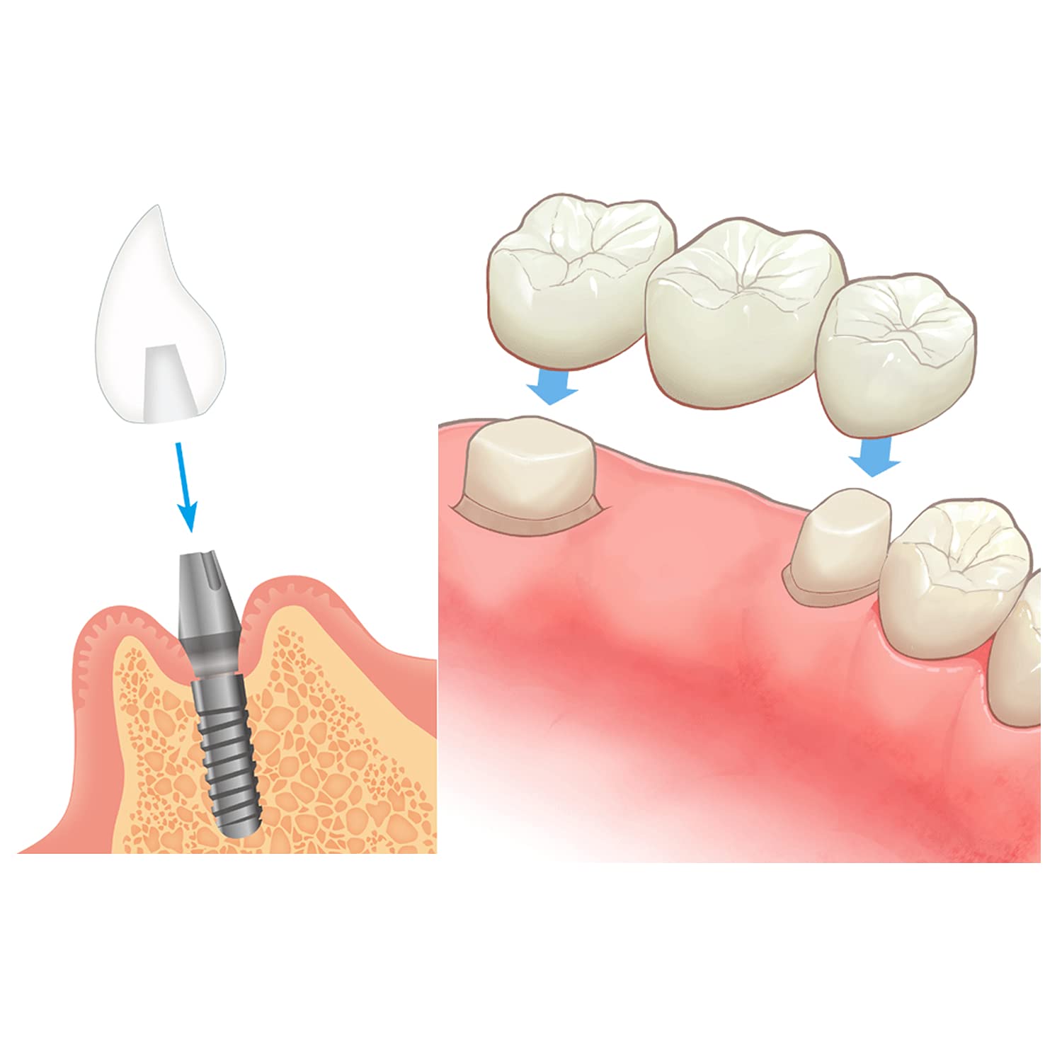 Snapklik.com : Dental Implant Typodont Restoration Teeth Model M6006 ...