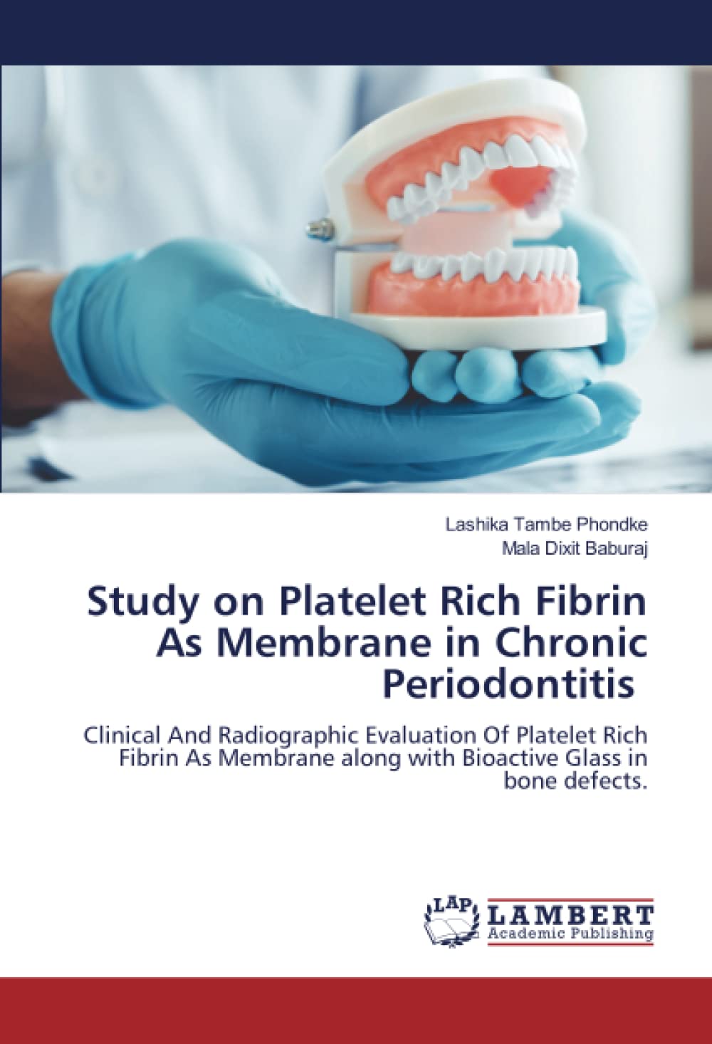Buy Study on Platelet Rich Fibrin As Membrane in Chronic Periodontitis ...