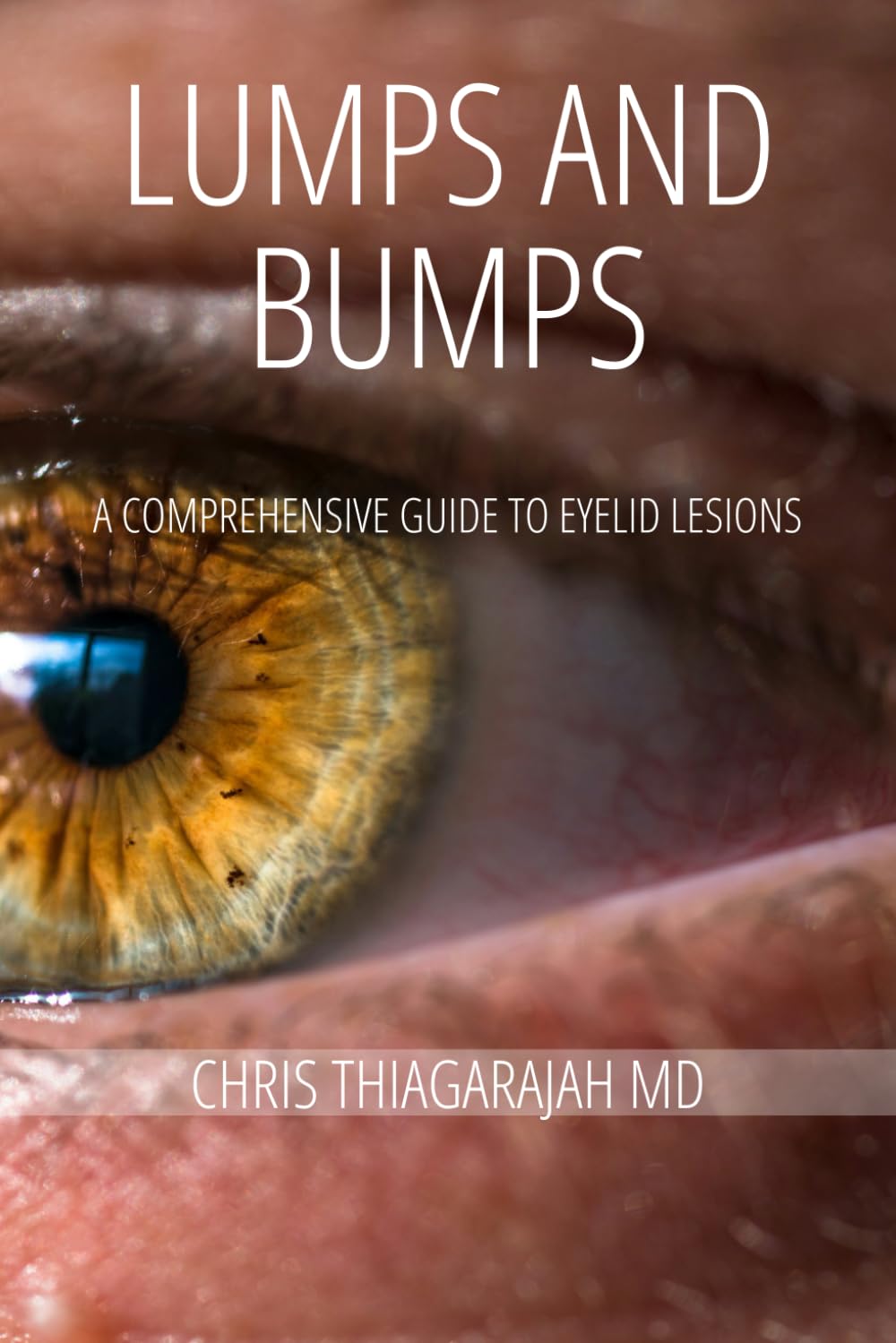 Lumps and Bumps: A Comprehensive Guide to Eyelid Lesions: Thiagarajah ...
