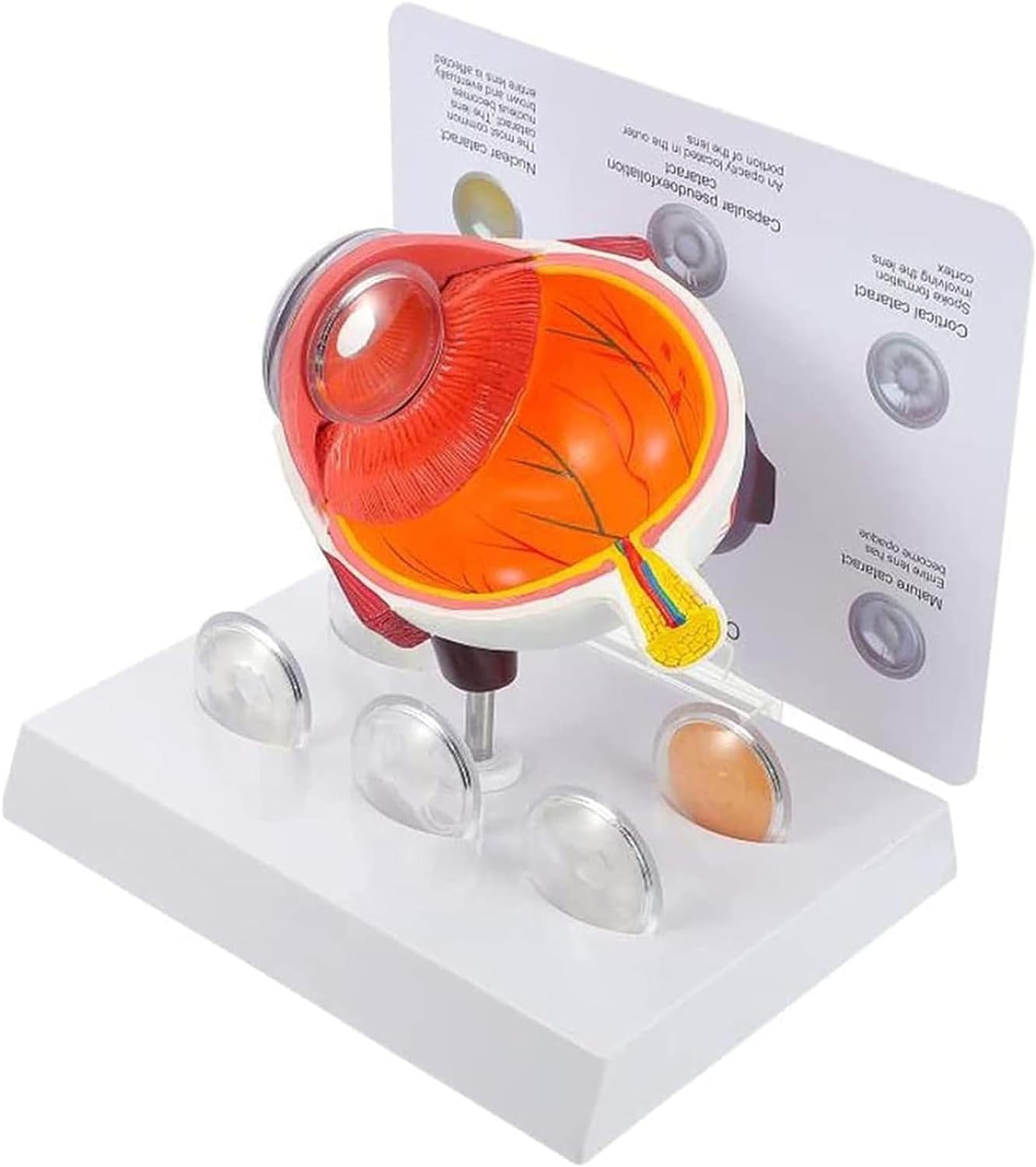 Cataract Eye Anatomy Model, Anatomical Model of The Nepal | Ubuy
