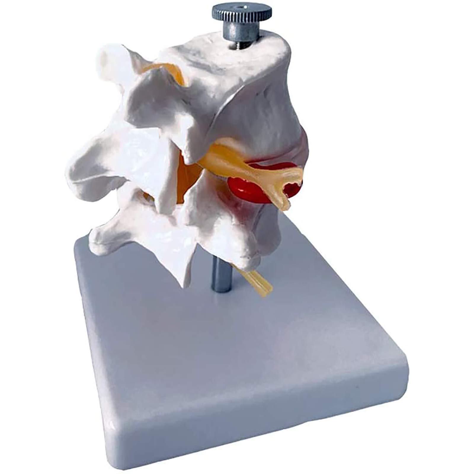 Buy Anatomical Model Spine Lumbar Disc Herniation Model Anatomical ...
