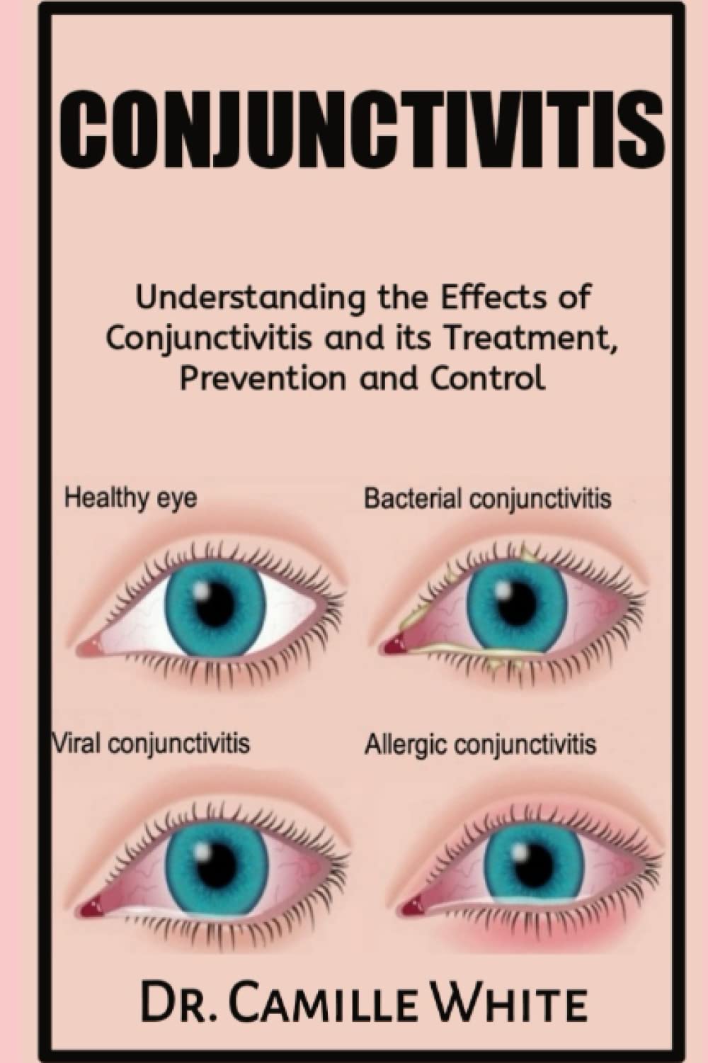 Buy CONJUNCTIVITIS: Understanding the Effects of Conjunctivitis and its , Prevention and Control ...
