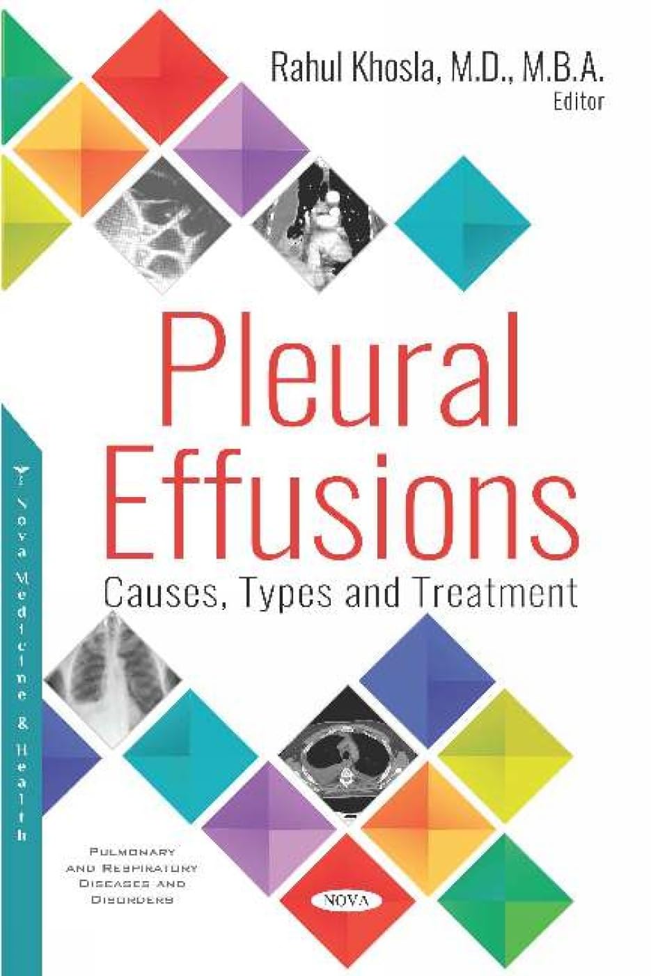 Pleural Effusions: Causes, Types and Treatment: 9781536146837: Medicine ...