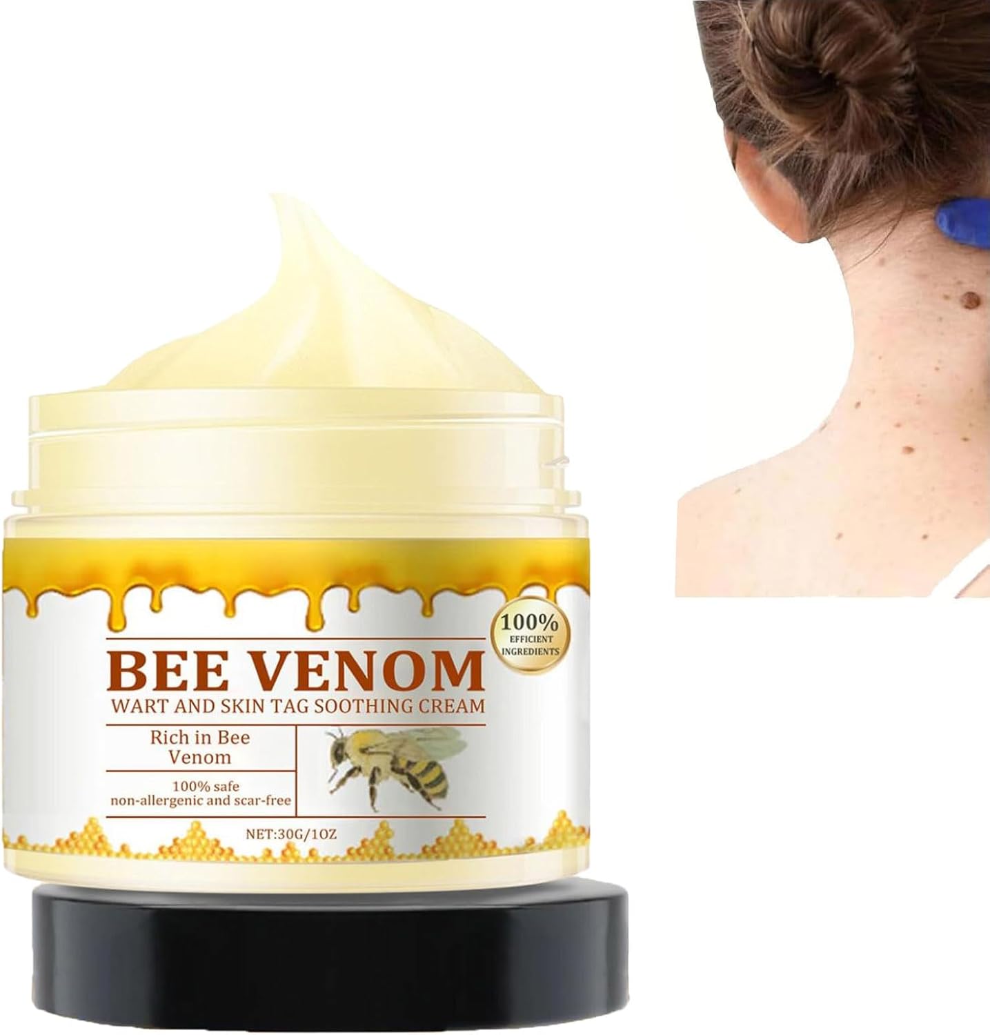 Bee Venom Moles and Warts Treatment Cream,Bee Venom Wart and Tag ...