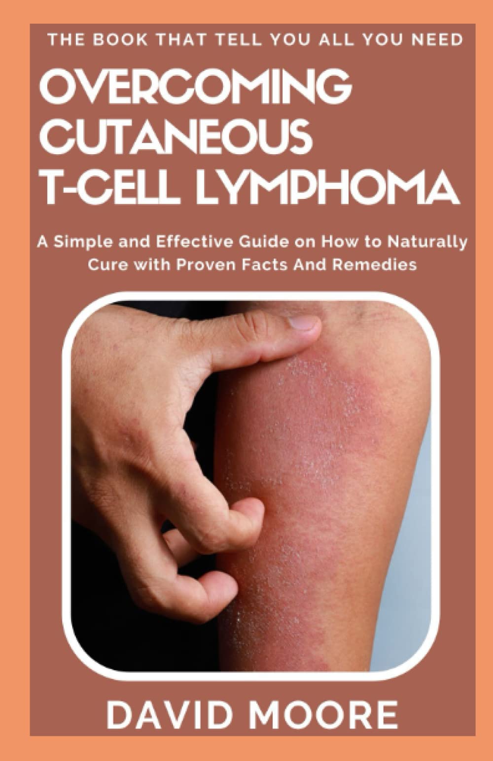 Buy Overcoming Cutaneous T-Cell Lymphoma: A Simple and Effective Guide ...