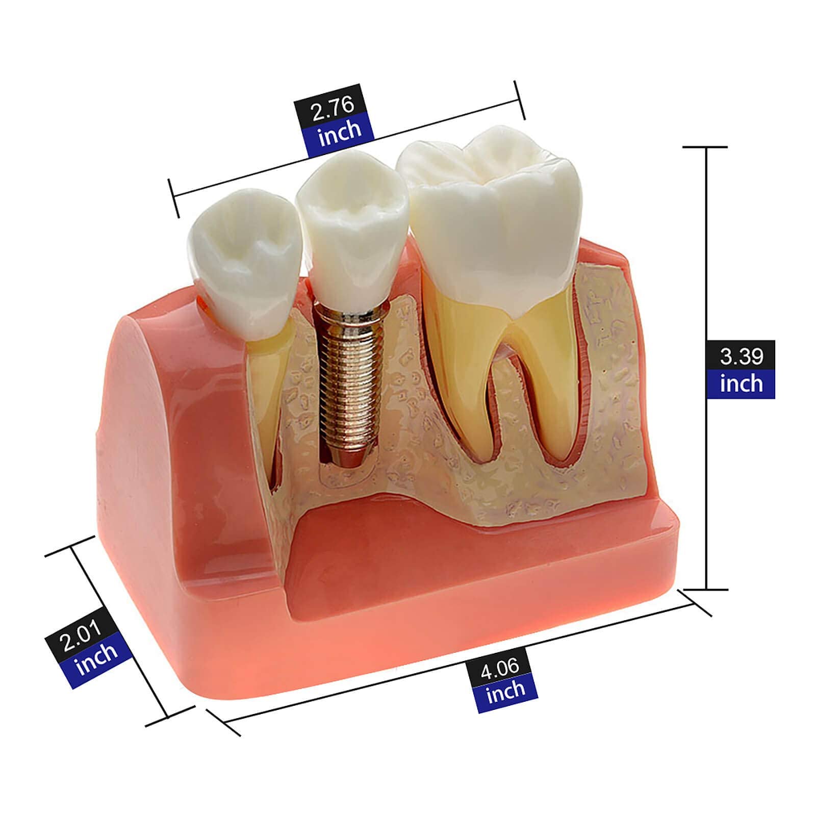 AZDENT Dental Model Implant Analysis Crown Bridge Demonstration Teeth ...