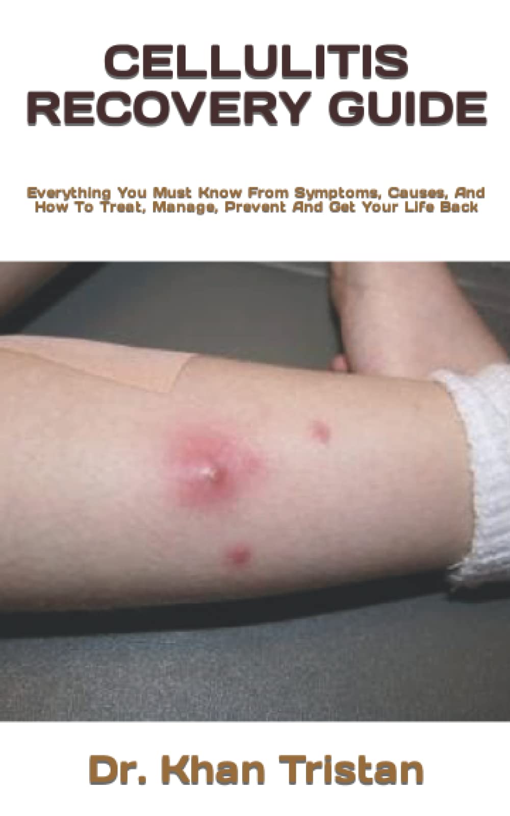 Buy CELLULITIS RECOVERY GUIDE: Everything You Must Know From Symptoms ...