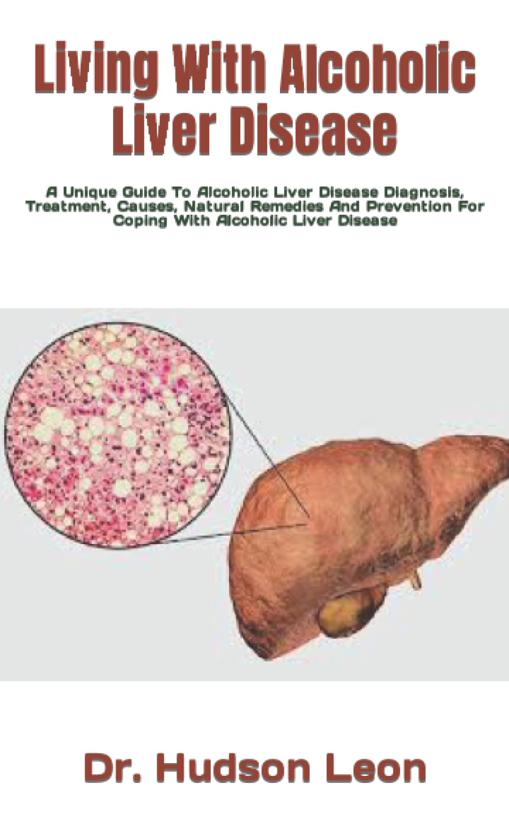 Buy Living With Alcoholic Liver Disease: A Unique Guide To Alcoholic ...