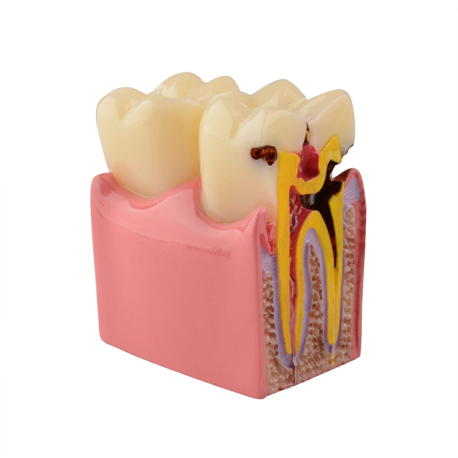 Snapklik.com : Ultrassist Dental Tooth Decay Model 6 Times Dental ...