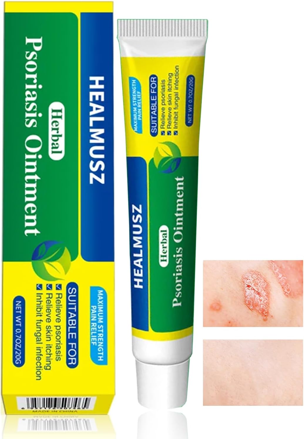 Herbal Psoriasis Cream, Psoriasis And Eczema Cream,Anti Fungal Skin ...