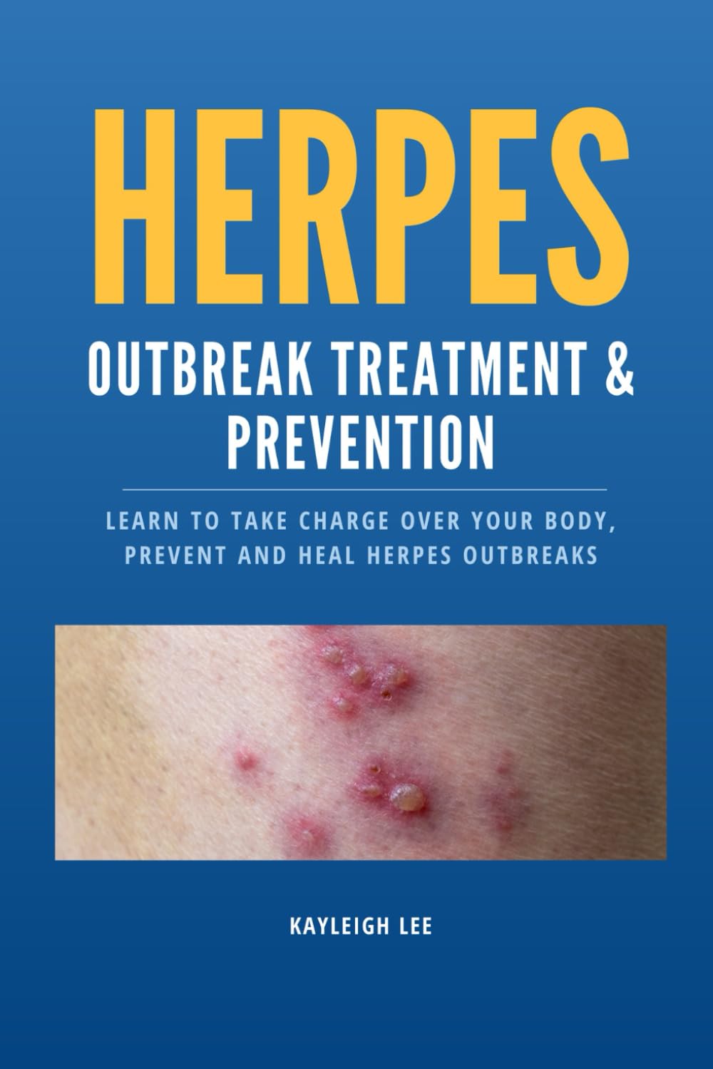 Outbreaks Herpes