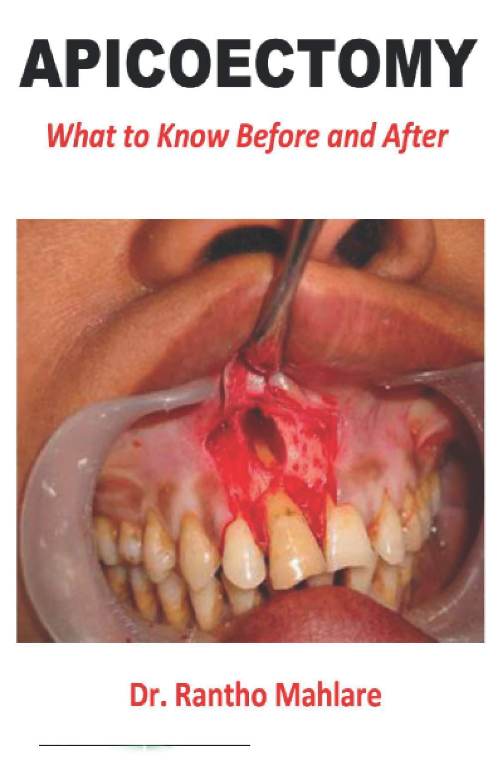 APICOECTOMY: What to Know Before and After: Mahlare, Dr. Rantho ...