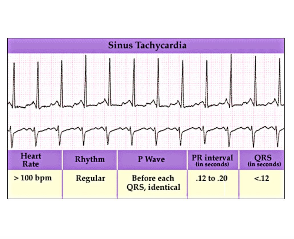 Buy 12 Lead EKG Electrocardiogram Training, EKG Basics, And ECG EKG ...