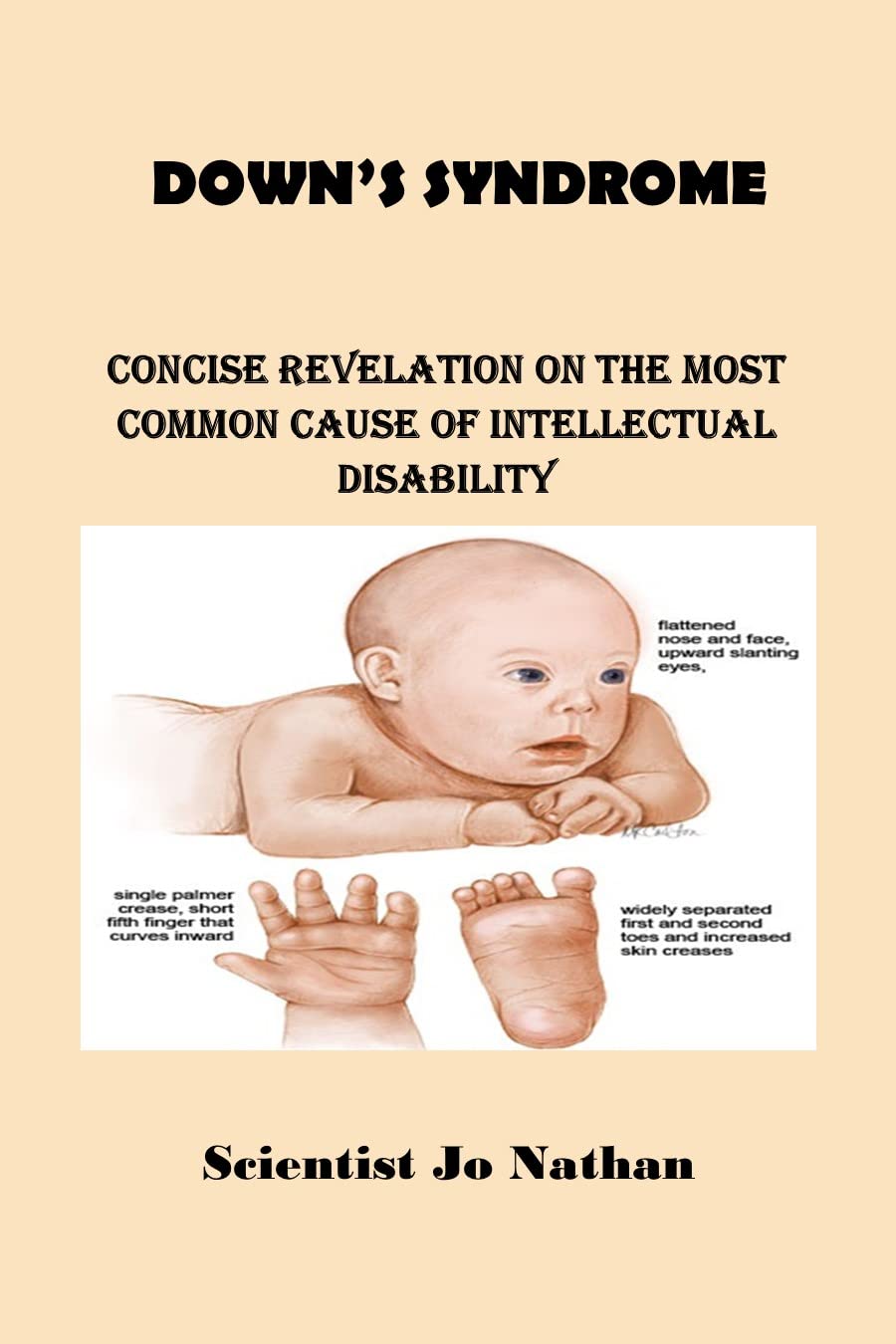 DOWN SYNDROME: Concise Revelation on The Most Common Cause of ...