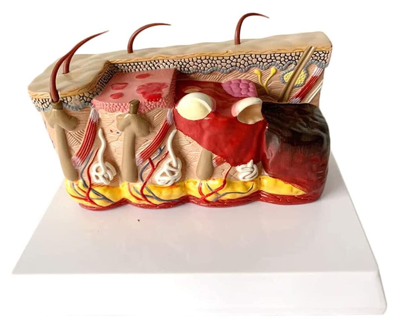 Buy Anatomy Model, Skin Burn Anatomical Model Pathological Skin Disease ...