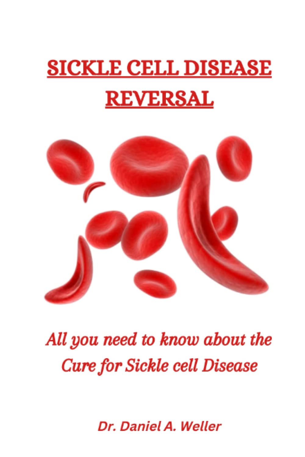 Sickle Cell Disease Reversal: All you need to know about the Cure for ...