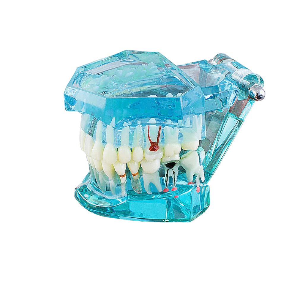 Snapklik.com : Transparent Disease Teeth Model, YOUYA DENTAL ...