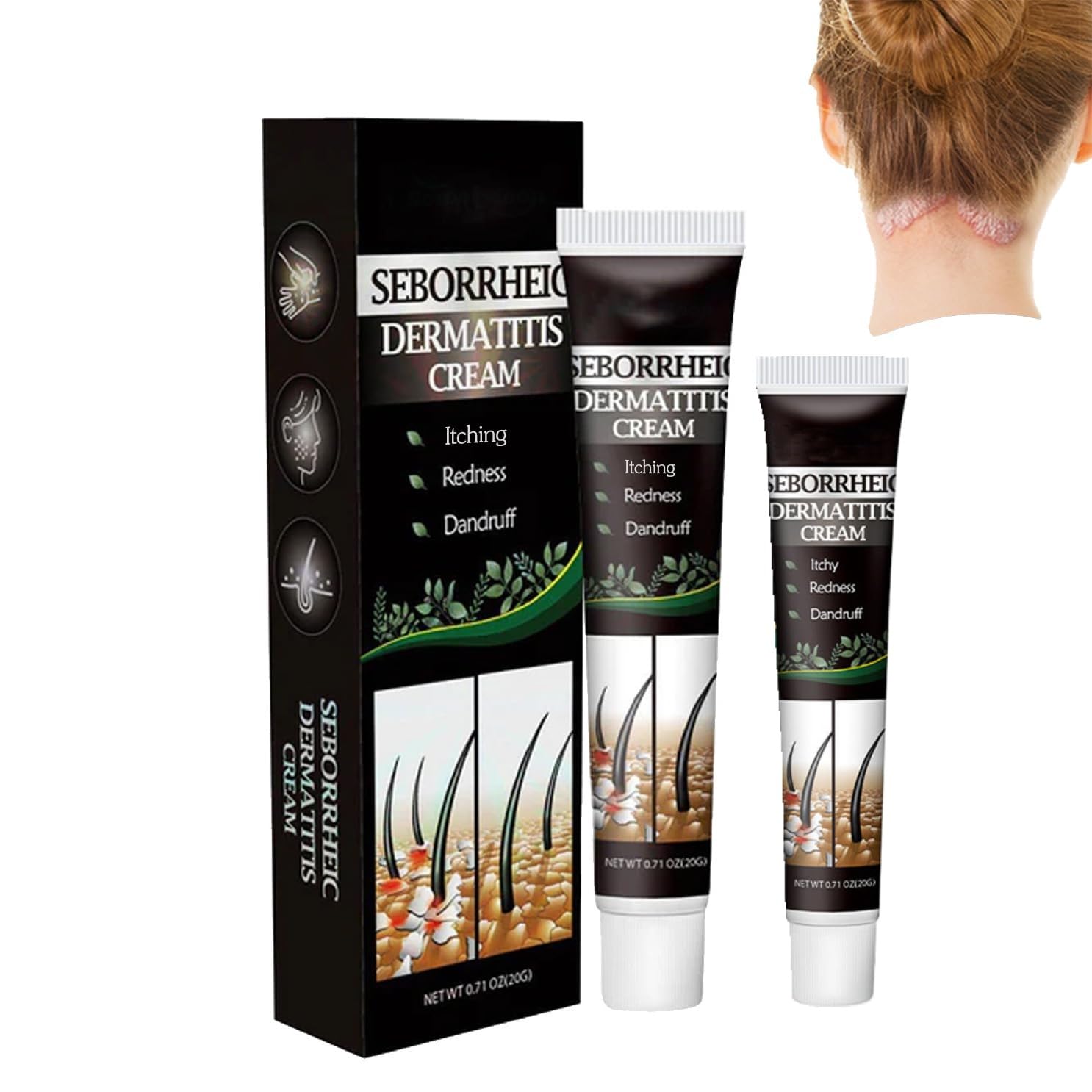 Nalacal Seborrheic Dermatitis Cream 20g Effective Treatment For ...