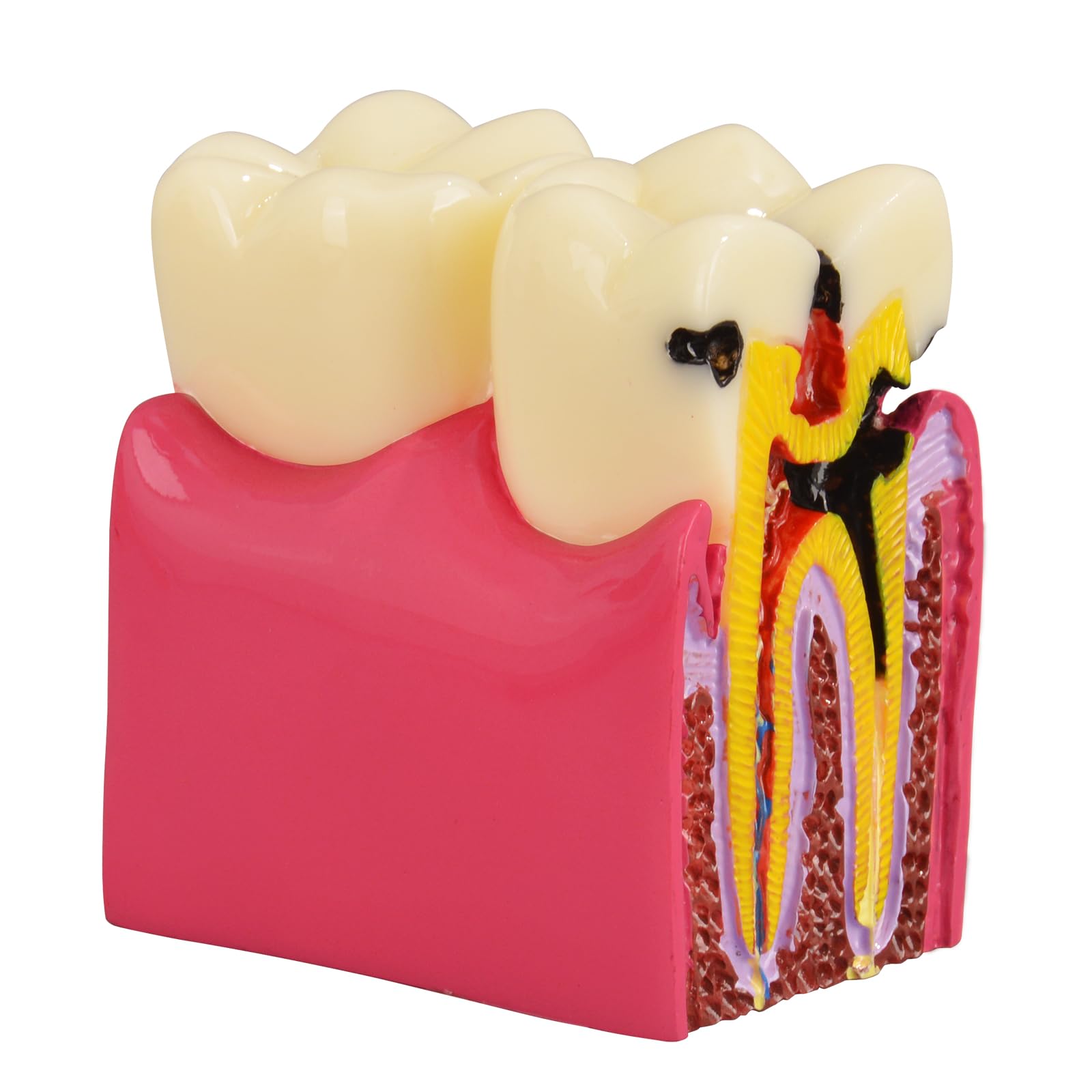 Snapklik.com : Ultrassist Dental Tooth Decay Model 6 Times Dental ...