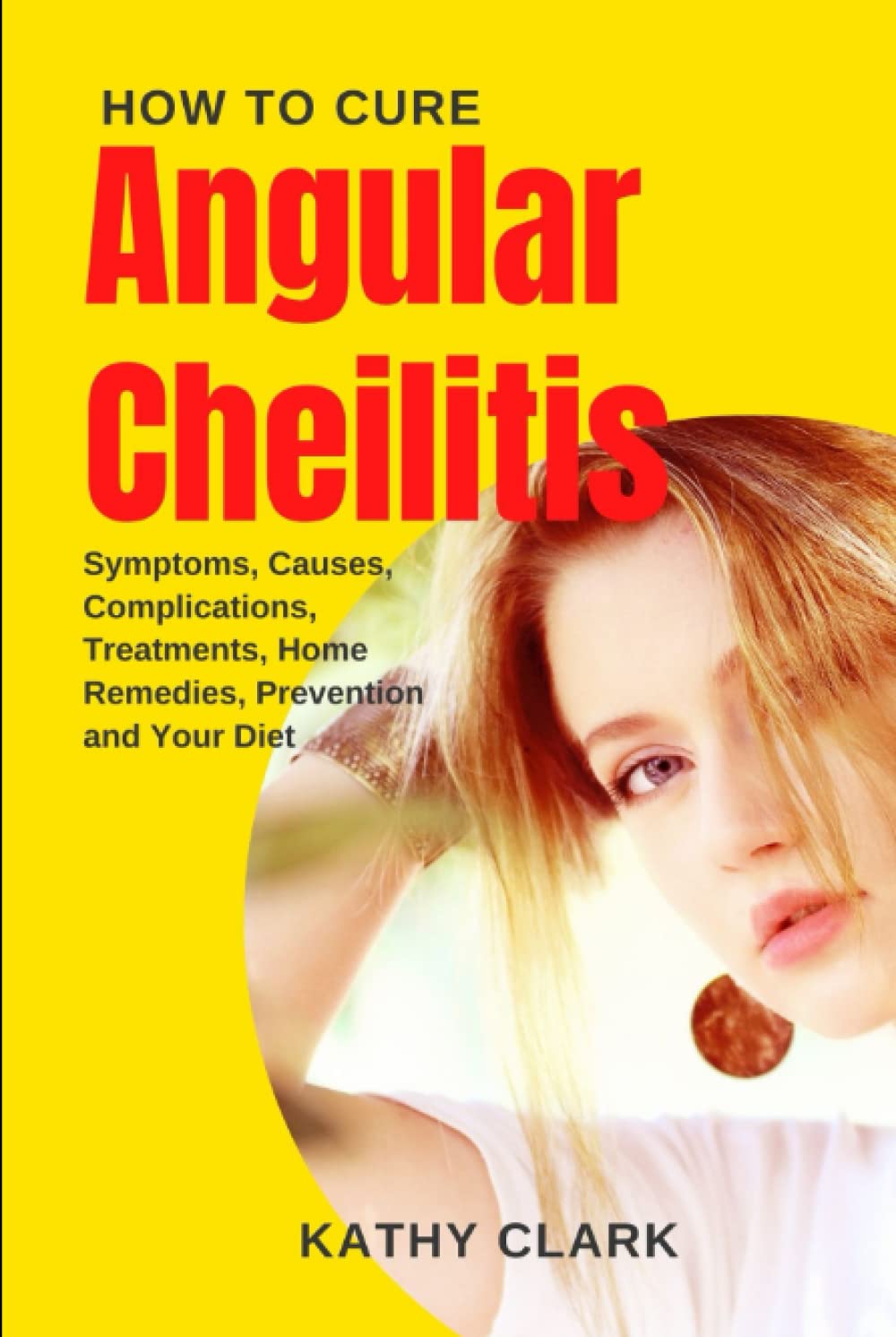 Buy Angular Cheilitis: How To Cure Angular Cheilitis, Symptoms, Causes ...