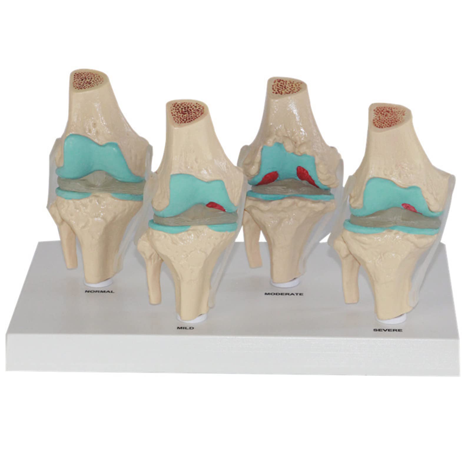 Buy Human Knee Joint Model, Human Body Anatomy Replica Set Of 4-Stage ...