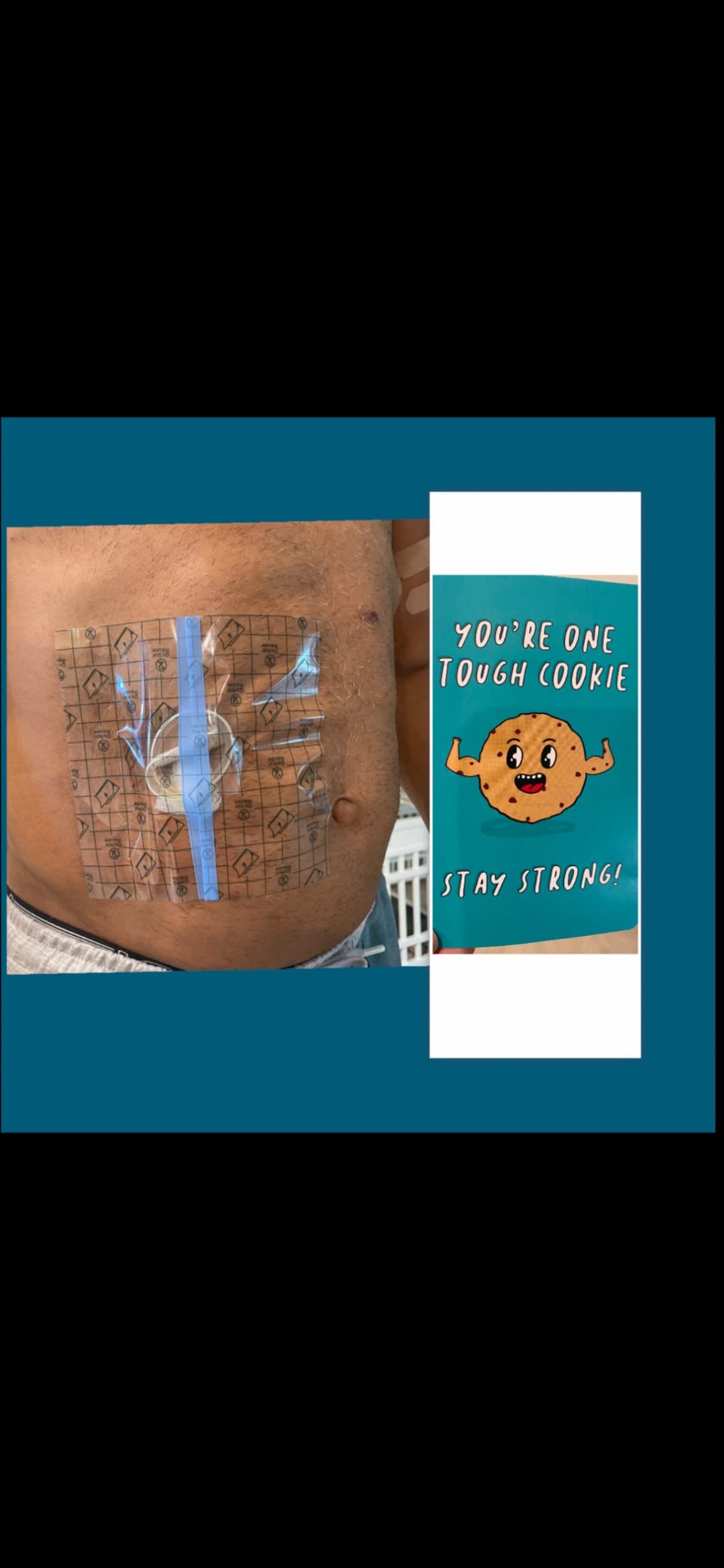 Amazon.com: Waterproof Shower Cover Shields Peritoneal Dialysis Chest ...