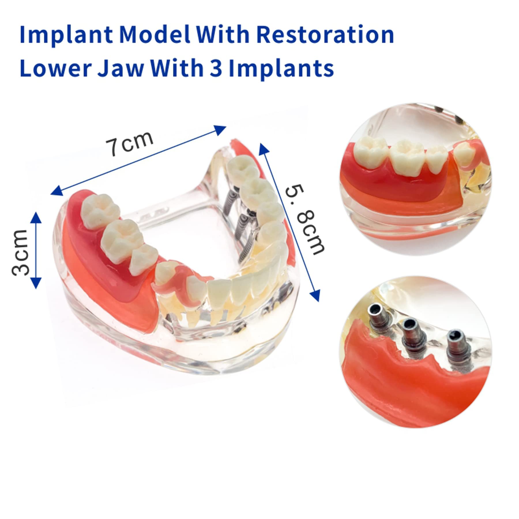 Snapklik.com : Dental Implant Typodont Restoration Teeth Model M6006 ...