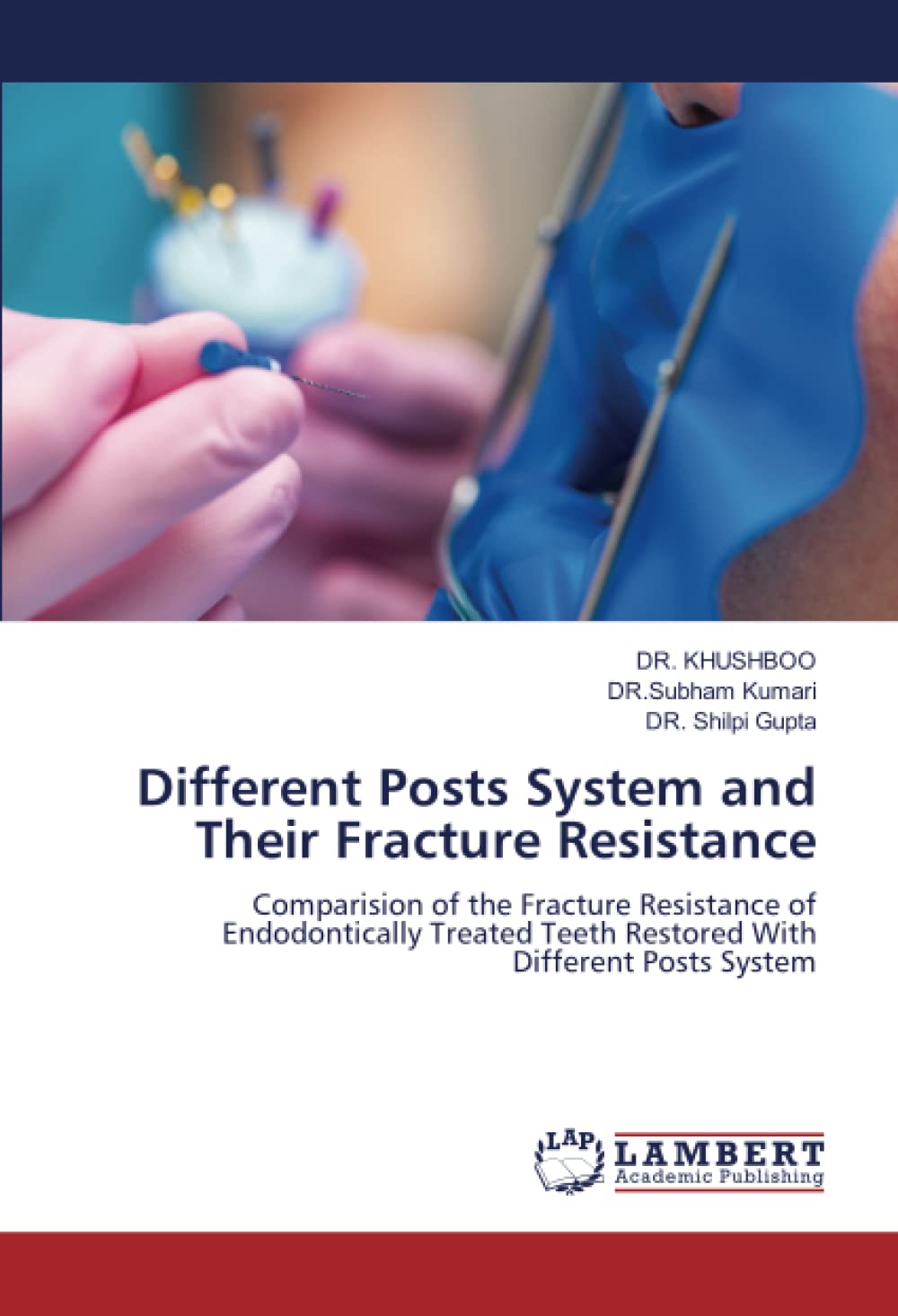 Buy Different Posts System and Their Fracture Resistance: Comparision ...