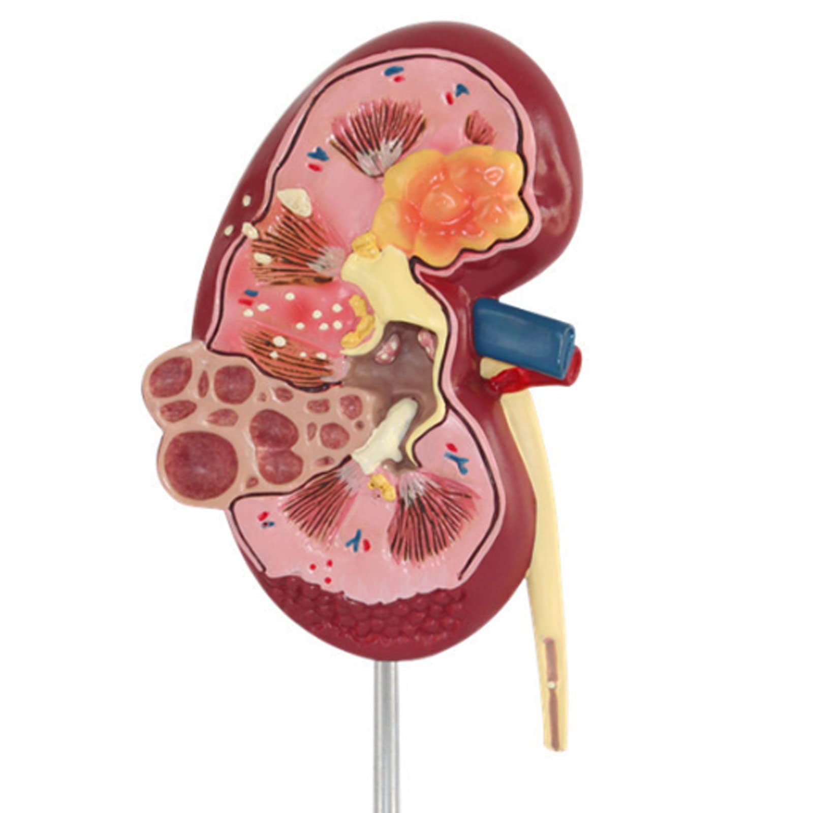 Buy Kidney Anatomical Model, Lesional kidney model with Double Sided ...