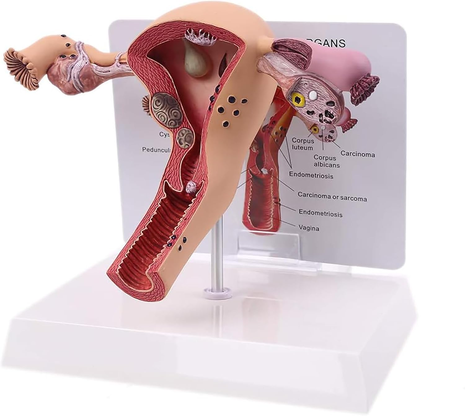 Amazon.com: UNbit Female Uterus Ovary Model, Pathology Model of Human Female Uterus Ovary ...