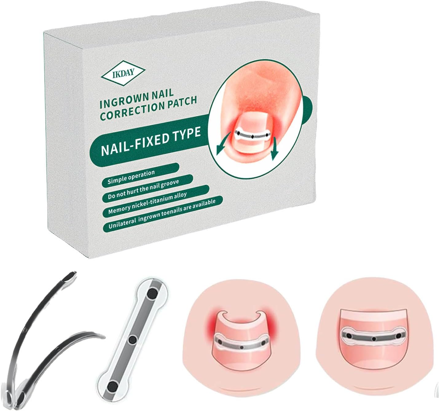 Amazon.com: Titanium Alloy Ingrown Toenail Treatment, Ingrown Toenail ...